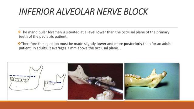 MANDIBULAR NERVE BLOCK in pediatric | PPTX