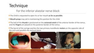 MANDIBULAR NERVE BLOCK in pediatric | PPTX