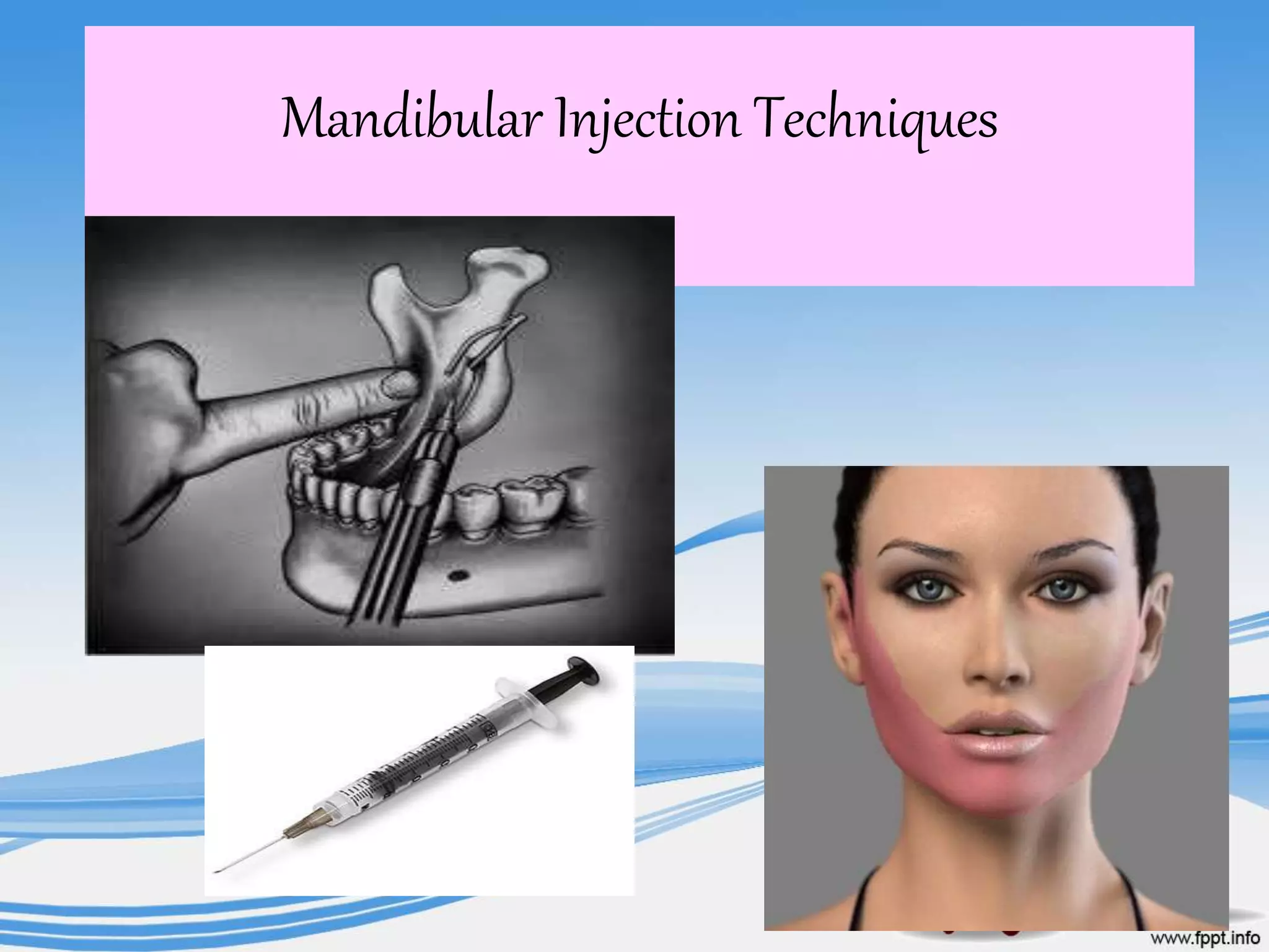 Local Anesthesia - Paedodontics | PPTX