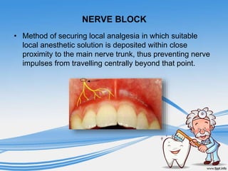 Local Anesthesia - Paedodontics | PPTX