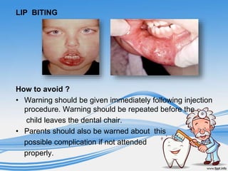 Local Anesthesia - Paedodontics | PPTX