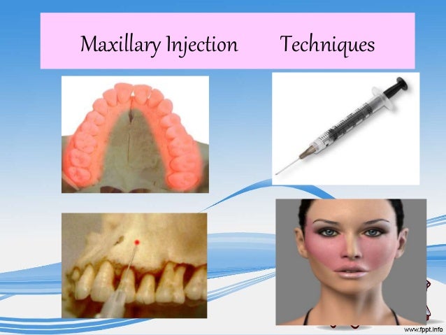 Local Anesthesia - Paedodontics