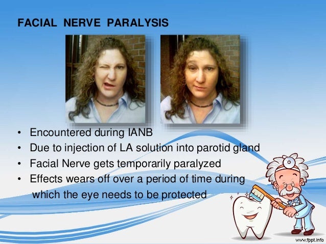 Local Anesthesia - Paedodontics