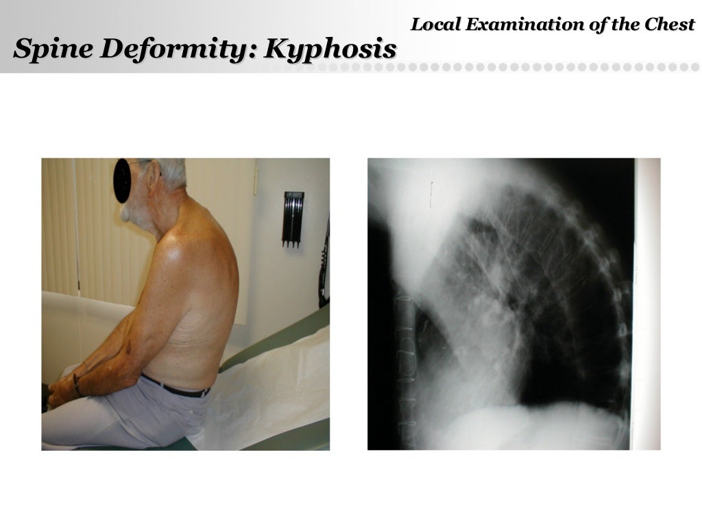 Clinical Examination Of The Chest Wall