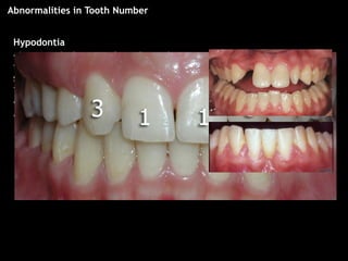 Local / Dental causes of Malocclusion | PPT