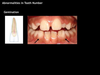 Local / Dental causes of Malocclusion | PPT
