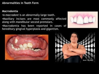 Local / Dental causes of Malocclusion | PPT