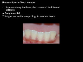 Local / Dental causes of Malocclusion | PPT