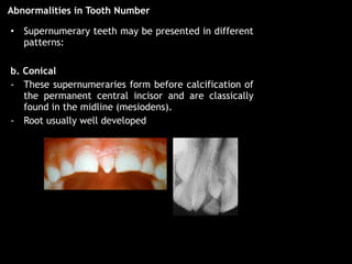 Local / Dental causes of Malocclusion | PPT