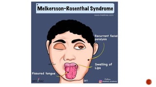 Local disorder of tongue.pptx