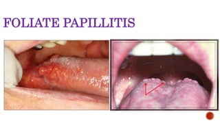 Foliate Papillitis