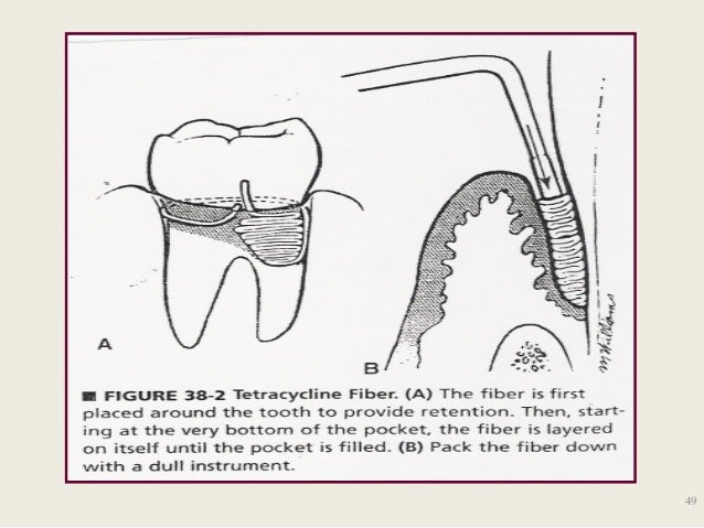 Local drug delivery system