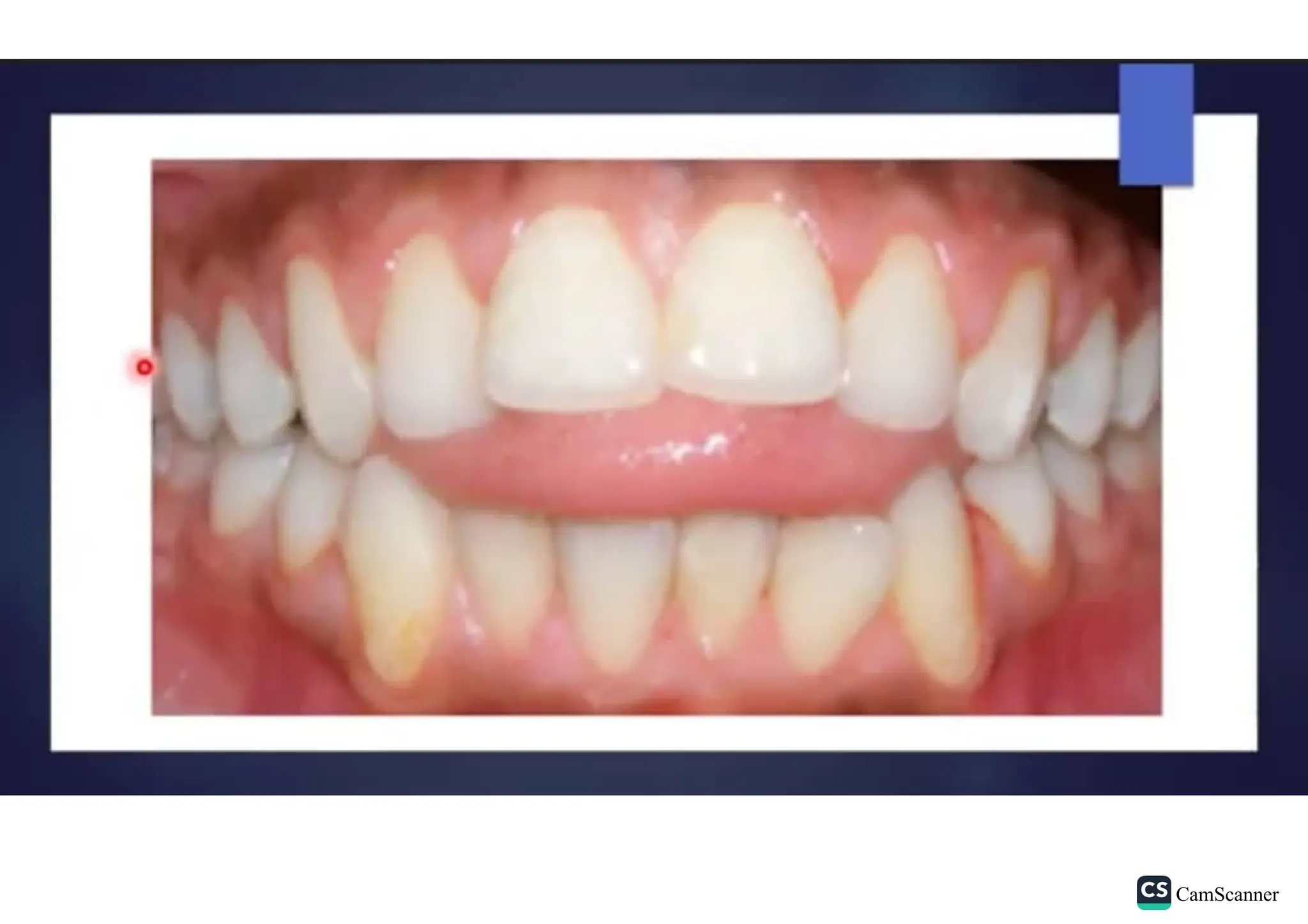 Local factors of periodontal diseases in the oral cavity | PPT