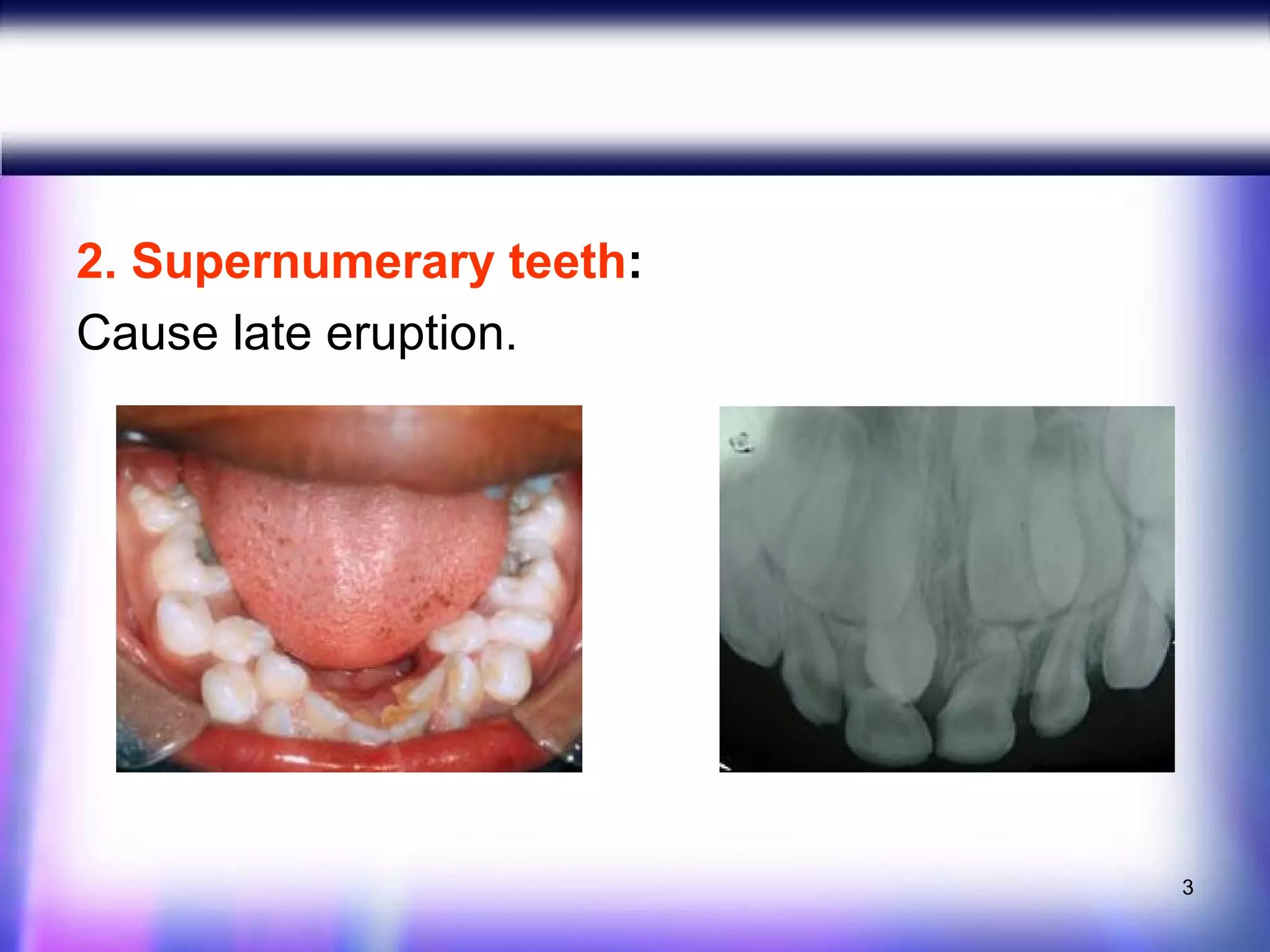 Local factors affect tooth eruption | PPT