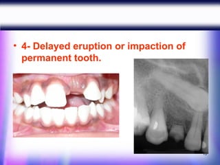 Local factors affect tooth eruption | PPT