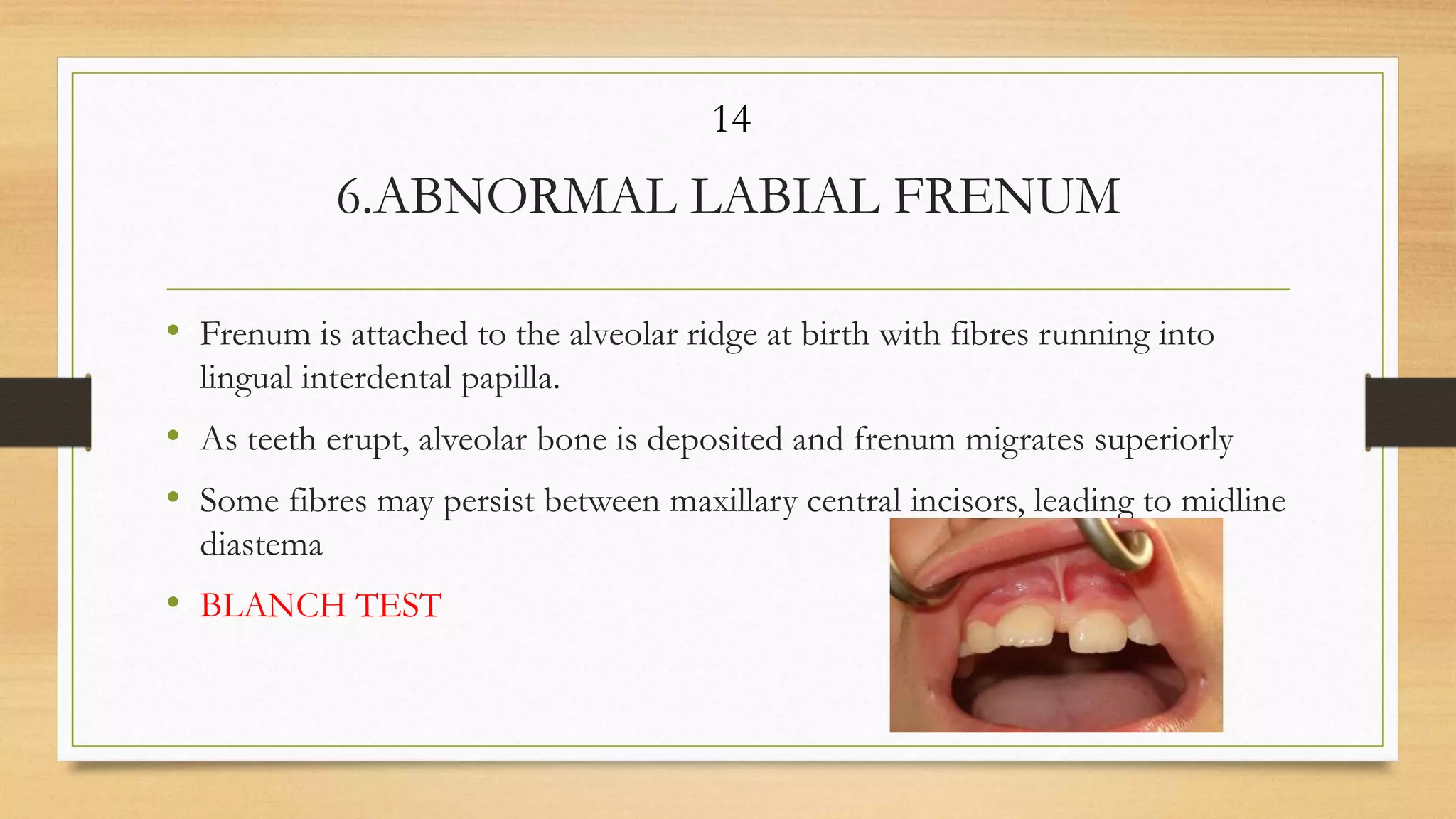 Local factors in etiology of malocclusion | PPTX