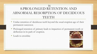 Local factors in etiology of malocclusion | PPTX