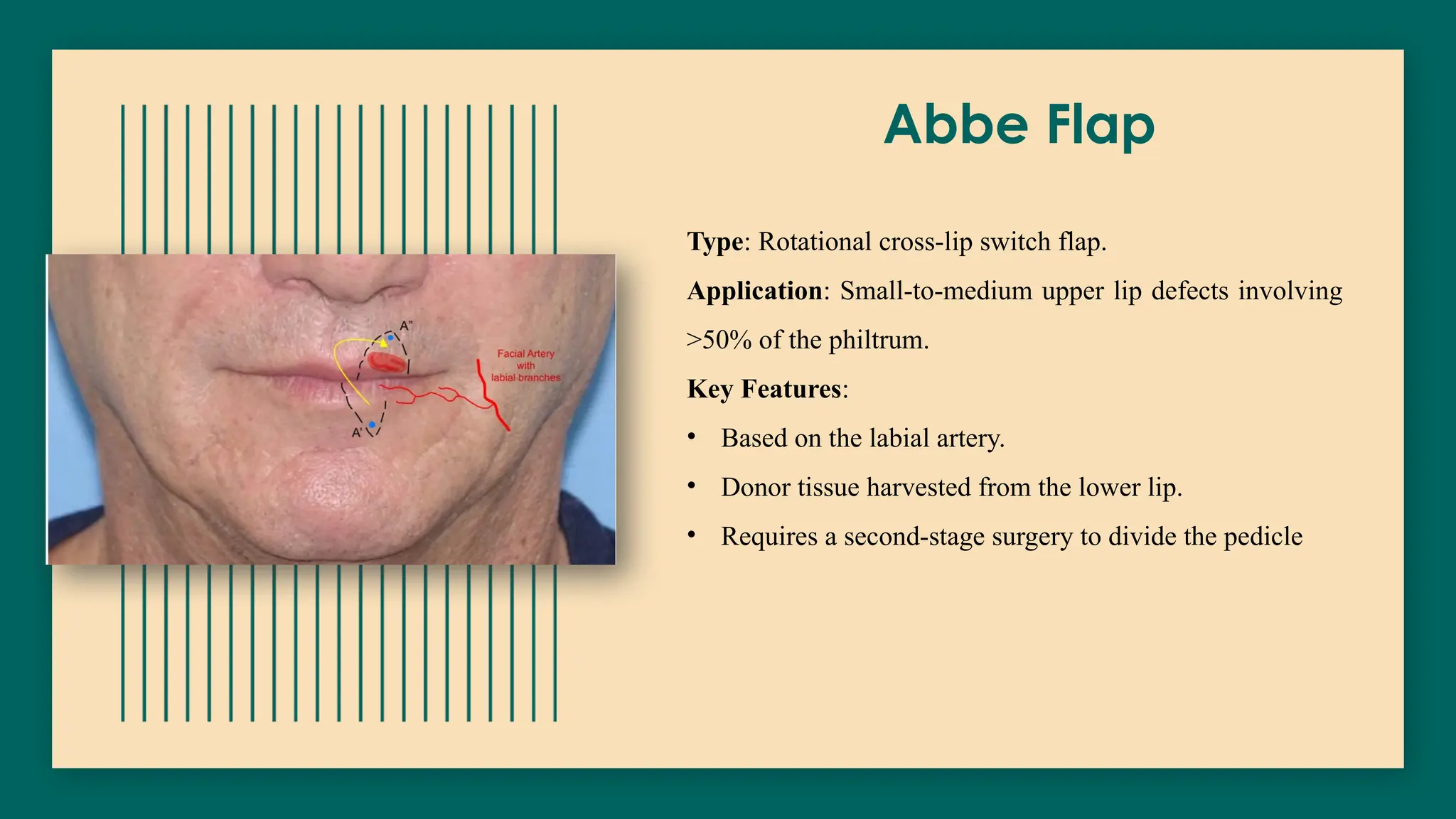 local flap IN HEAD AND MAXILLOFACIAL SUR | PPTX