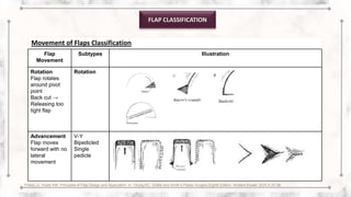 Local Flap of Lower Extremity.pptx