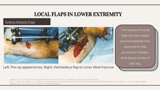 Local Flap of Lower Extremity.pptx