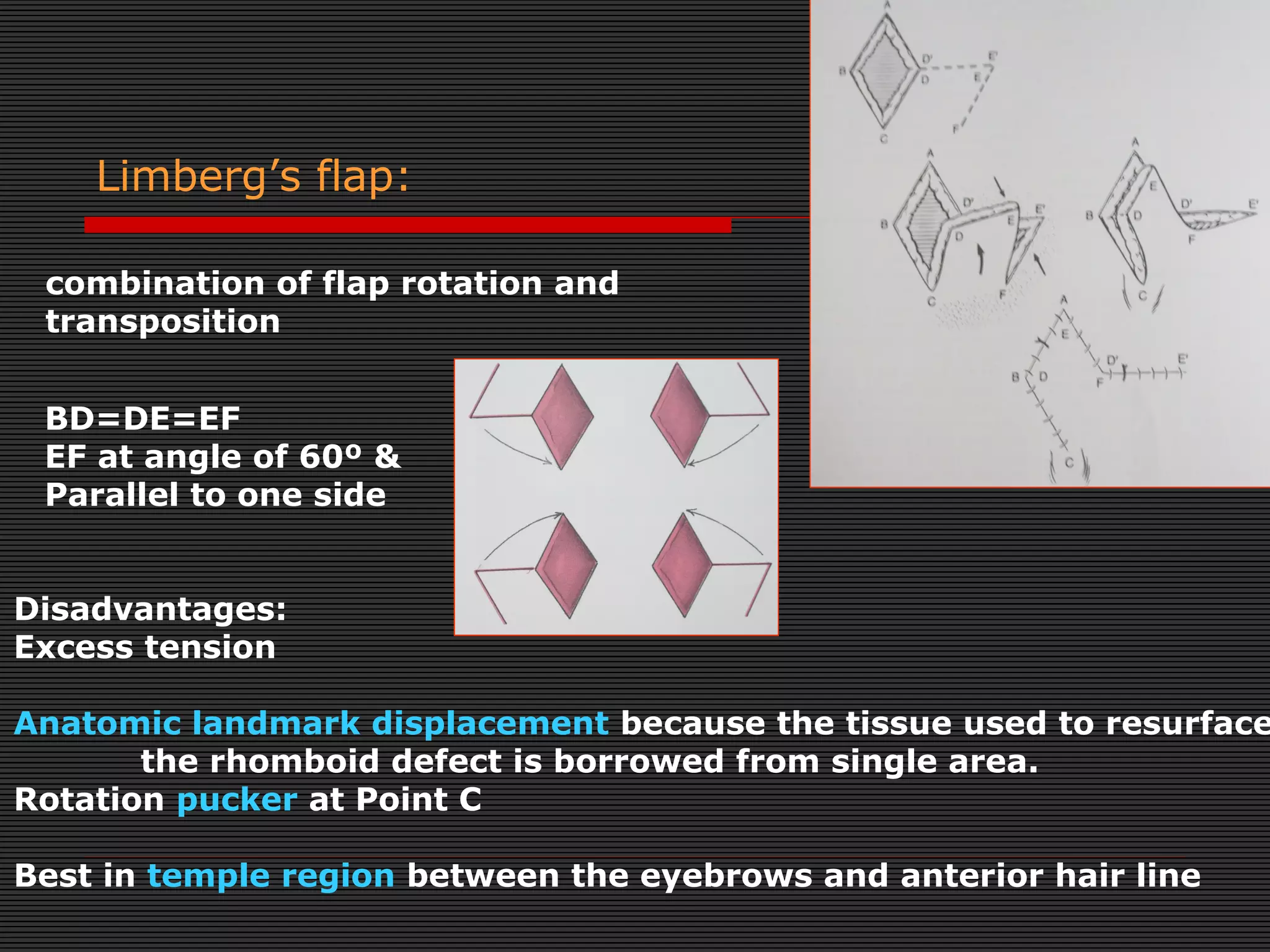 Local flaps | PPT