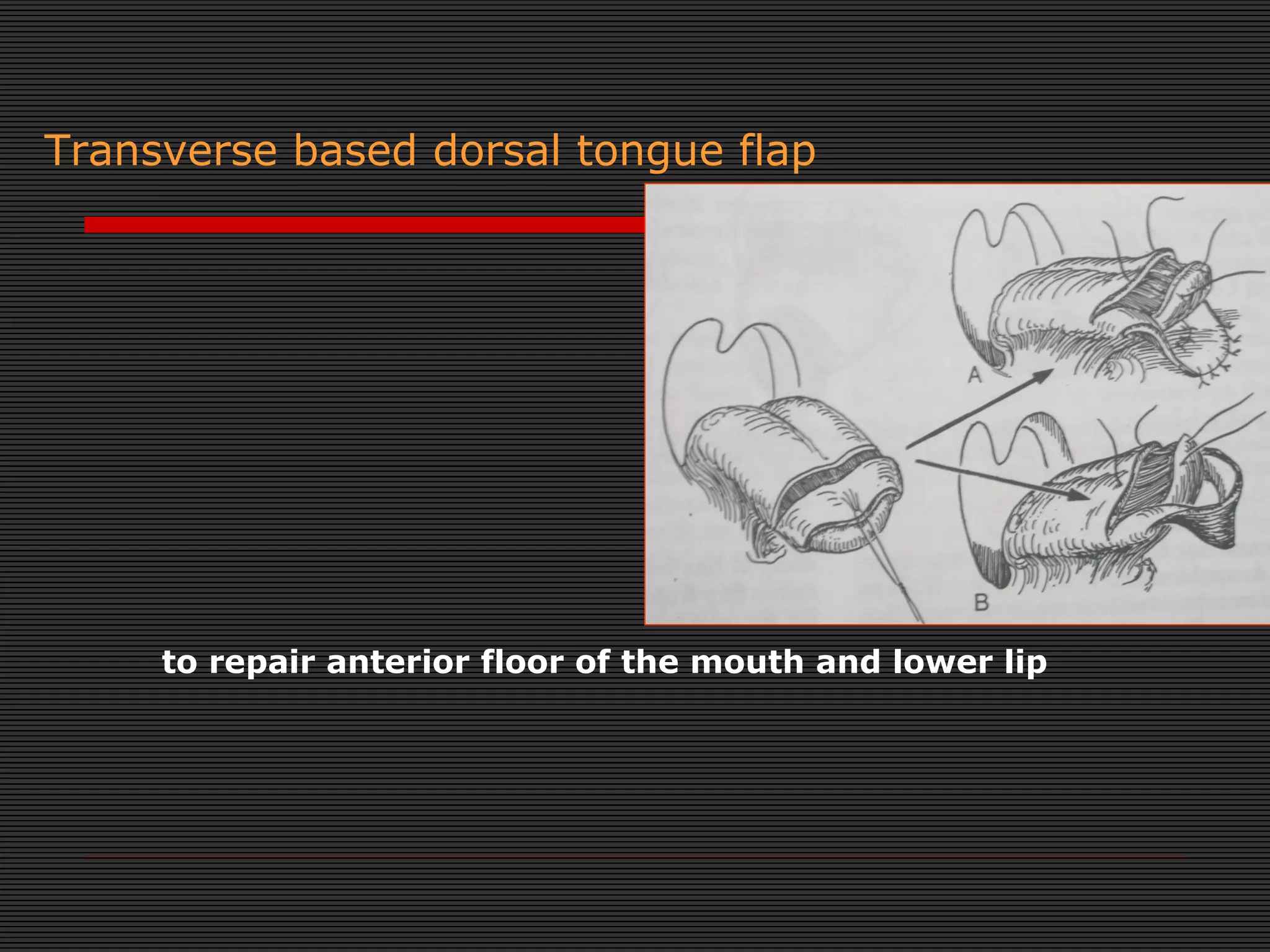 Local flaps | PPT | First Aid | Injuries
