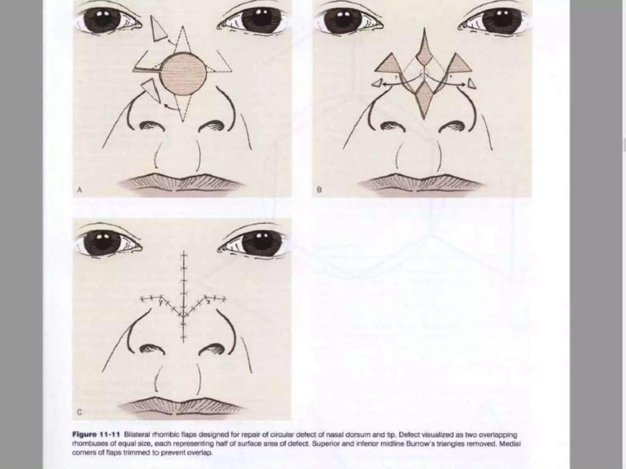 Local flaps classifications | PPTX