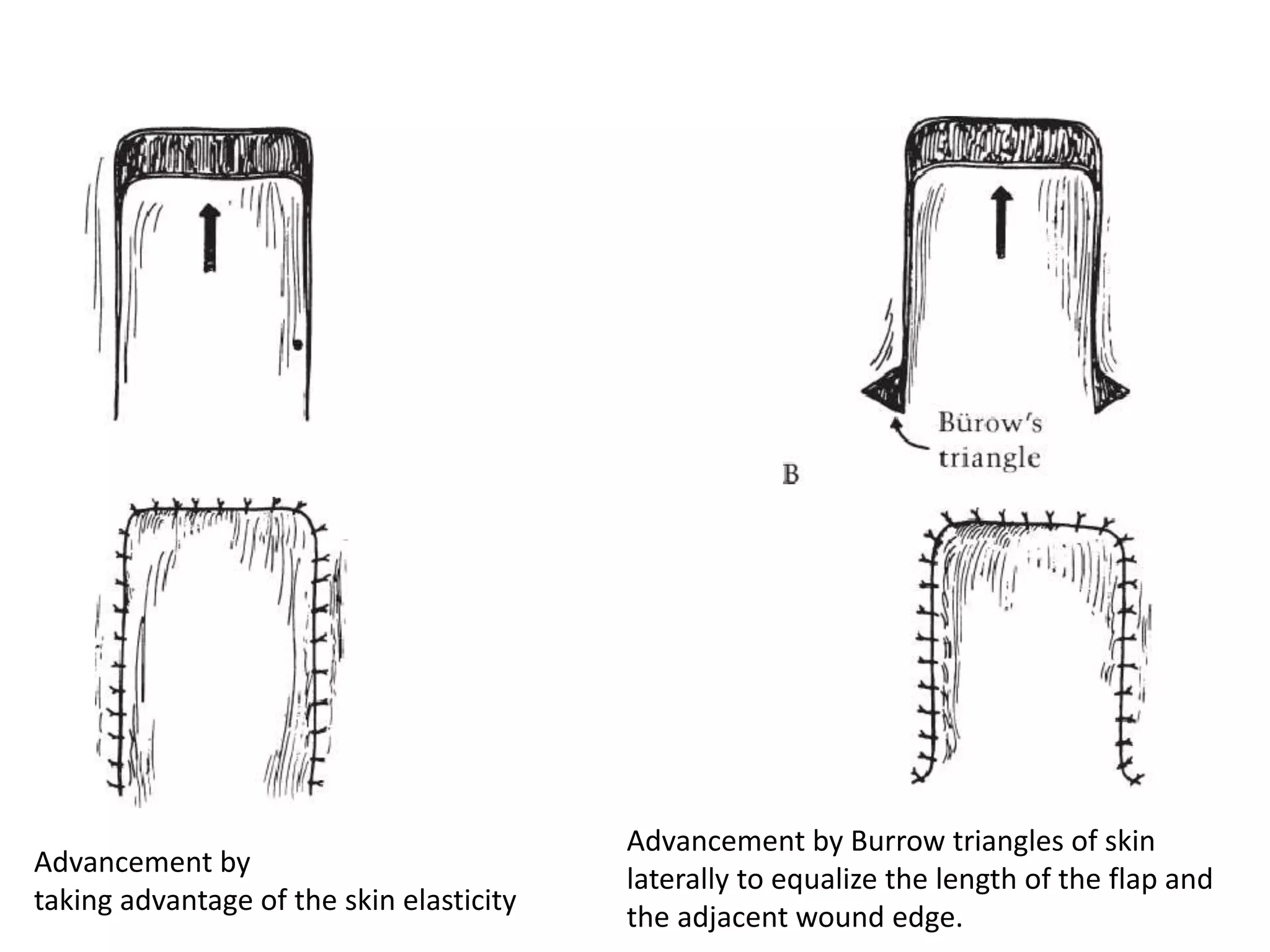 Local flaps classifications | PPTX