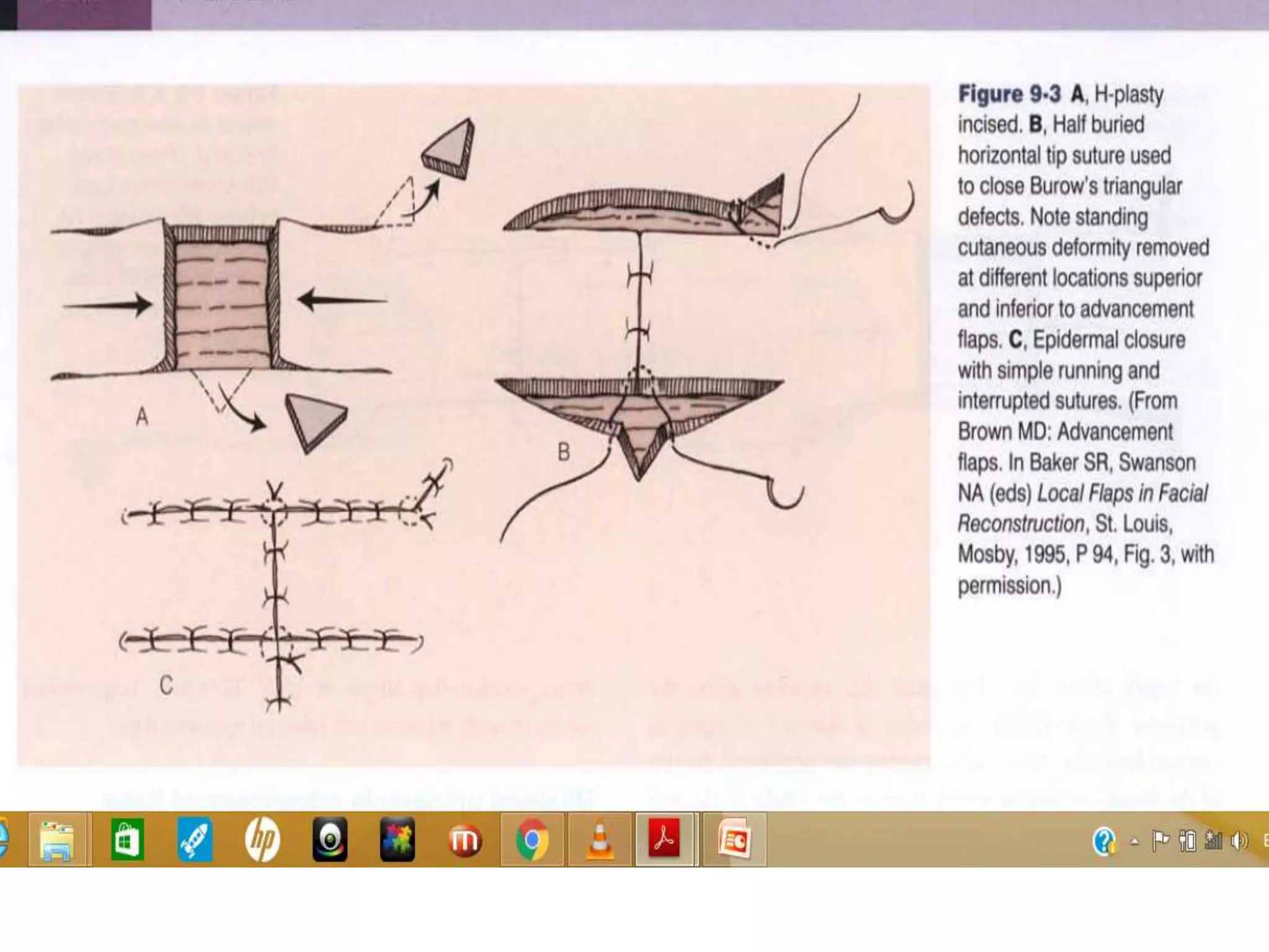 Local flaps classifications | PPTX