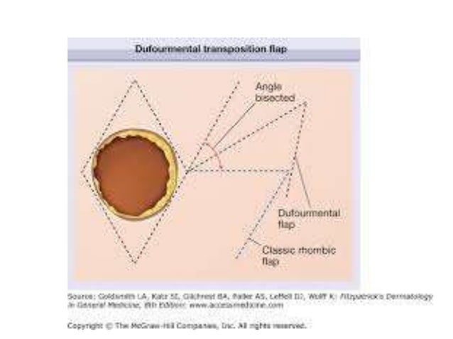 Local flaps classifications | PPTX
