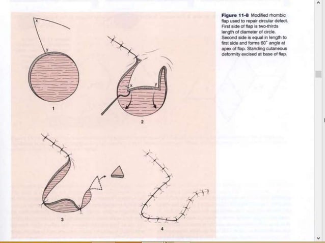 Local flaps classifications | PPTX