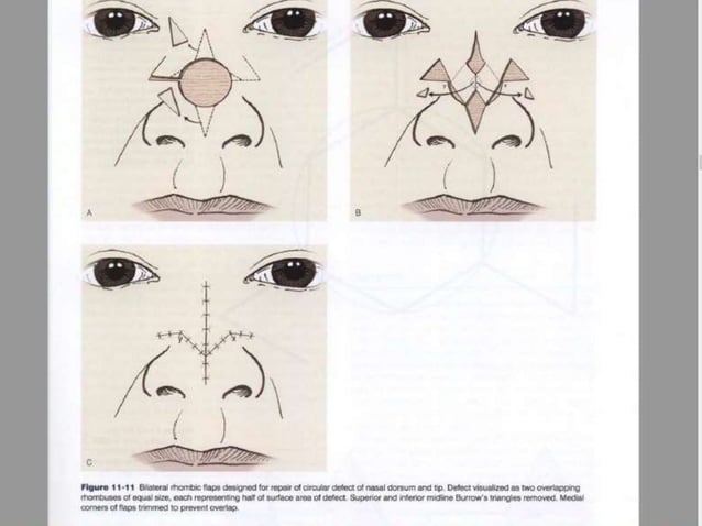 Local flaps classifications | PPTX