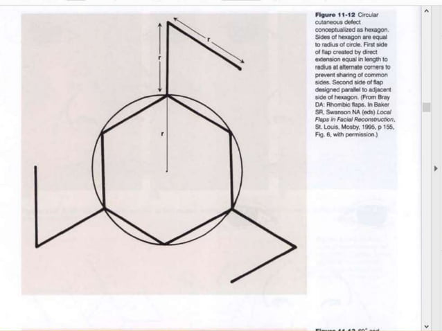 Local flaps classifications | PPTX