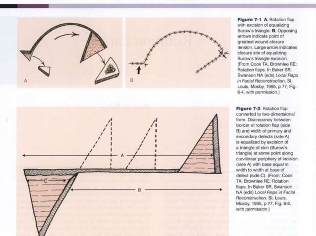 Local flaps classifications | PPTX