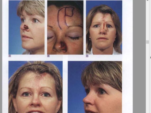 Local flaps classifications | PPTX