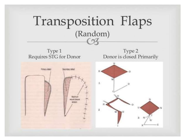 Local flaps classifications | PPTX