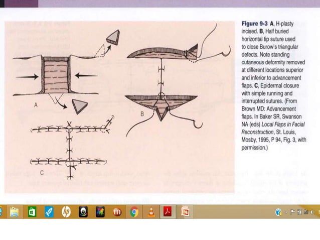 Local flaps classifications | PPTX