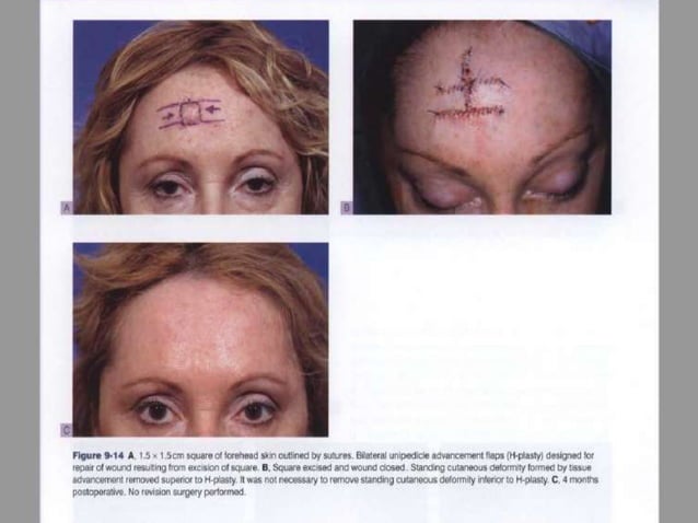 Local flaps classifications | PPTX