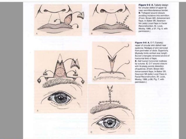 Local flaps classifications | PPTX