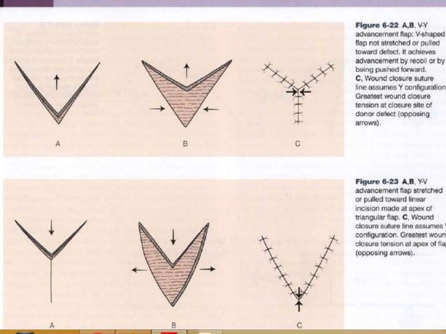 Local flaps classifications | PPTX
