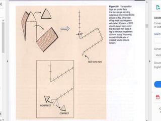 Local flaps classifications | PPTX
