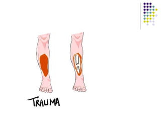 Local Flaps For Lower Limb Reconstruction Version1 | PPT