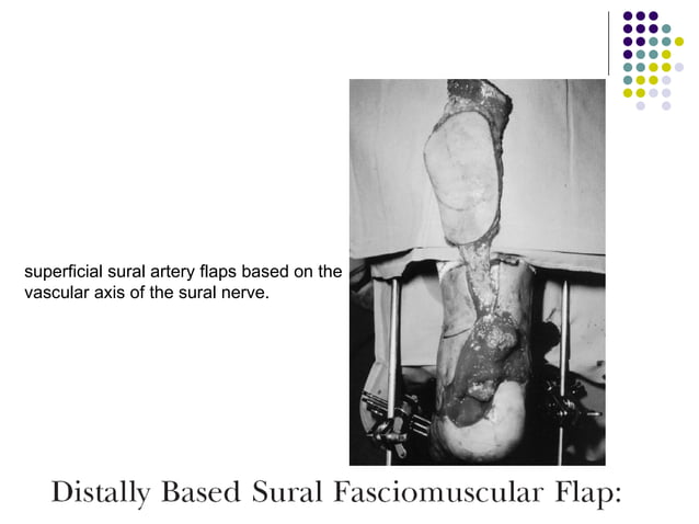 Local Flaps For Lower Limb Reconstruction Version1 | PPT