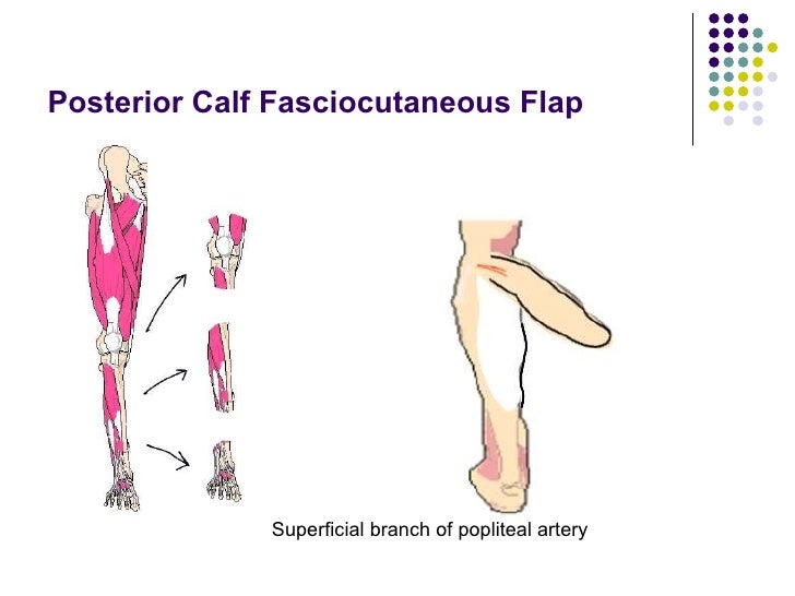 Local Flaps For Lower Limb Reconstruction Version1