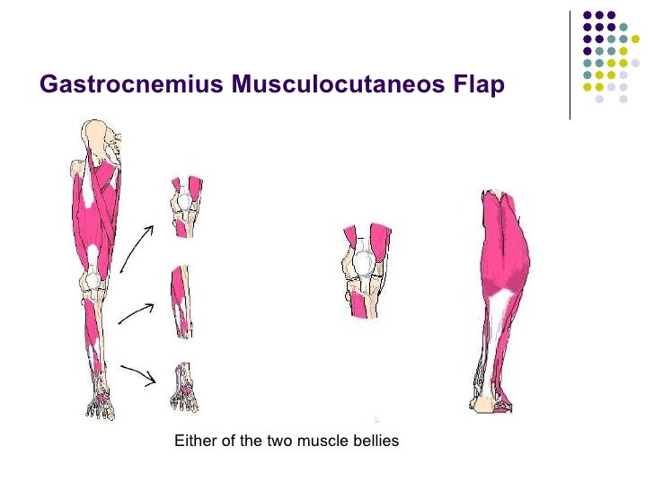 Local Flaps For Lower Limb Reconstruction Version1