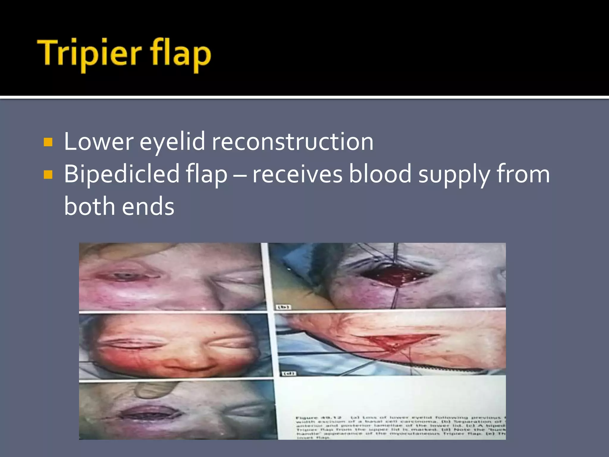 Local flaps in ent | PPTX
