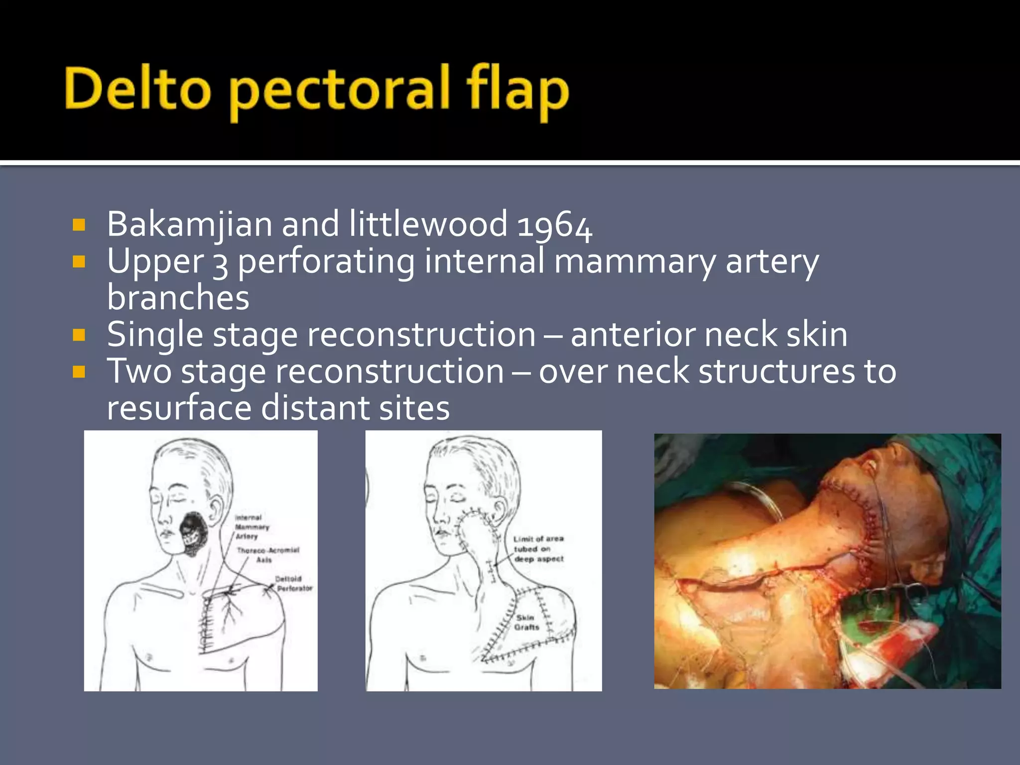Local flaps in ent | PPTX