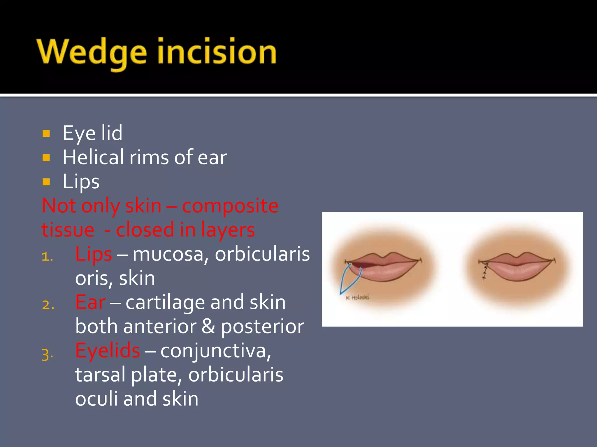 Local flaps in ent | PPTX
