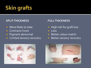 Local flaps in ent | PPTX