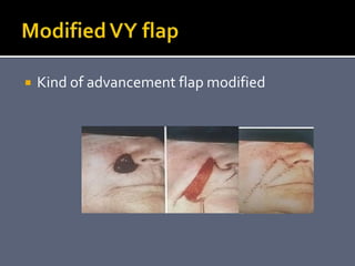 Local flaps in ent | PPTX